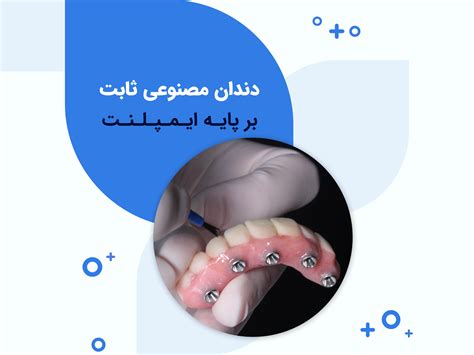 قیمت دندان مصنوعی ثابت بر پایه ایمپلنت