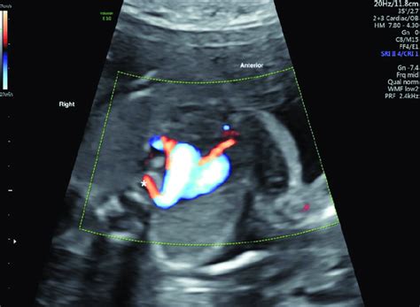 C Normal Three Vessel Trachea View By D Vci A Combined With High