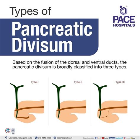 Pancreas Divisum Symptoms Causes Types Complications