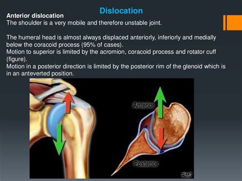 Shoulder Labral Tears Mri