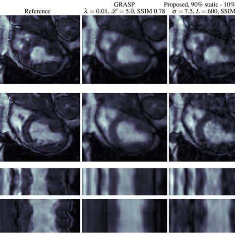 Reconstruction Using The Proposed Method In A Representative Patient