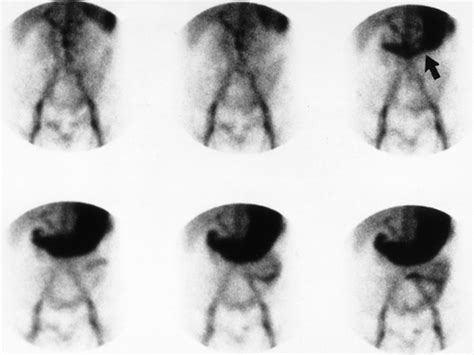 Gastrointestinal Liverspleen And Hepatobiliary Scintigraphy