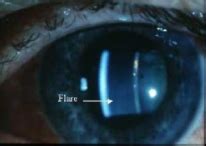 Lec 46 Ophthalmic Examination Flashcards Quizlet