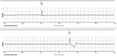 Implantable Loop Recorders