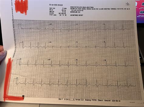 Sinus Arrythmia Incomplete Right Bundle Branch Block R Medical
