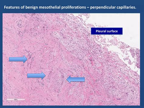 07 Histology Cytology And Biomarkers In Pleural Diseases Pdf