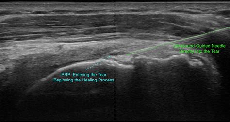 Rotator Cuff Regenerative Medicine Cure Tendonitis And Partial Tears