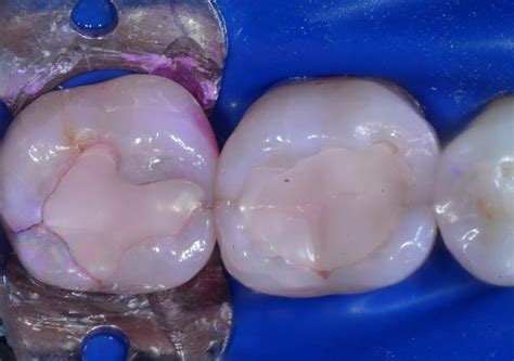 Bioclear Gallery Corner Stone Dental In Swansea Il