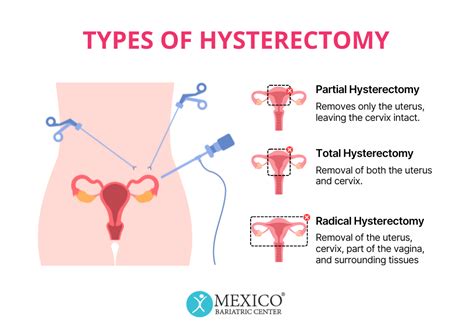 Hysterectomy In Tijuana Mexico Mexico Bariatric Center®