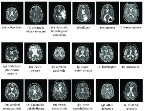 Sample Of Brain Mris Download Scientific Diagram