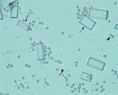 Urine Sediment Exam Struvite Crystals With Pus Cells And
