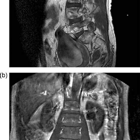 A T 1 Weighted Sagittal Mri Showing Internal Iliac Aneurysm B T