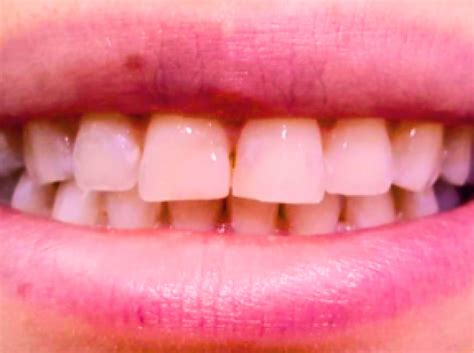 تركيبات الزيركون في تركيا Yessmile
