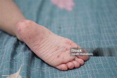 엔테로바이러스 또는 콕사키 바이러스에서 유래한 손 발 및 구강 질환 또는 Hfmd에 감염된 어린이의 발을 클로즈업하여 확대합니다