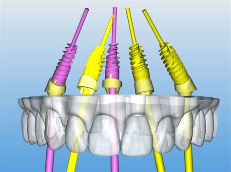 Realguide Treatmentplanning Cad Guidedsurgery Steve Kauffmann