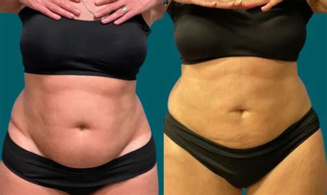 Body Contouring Lipo Laser Treatment STL Weight Loss Secret