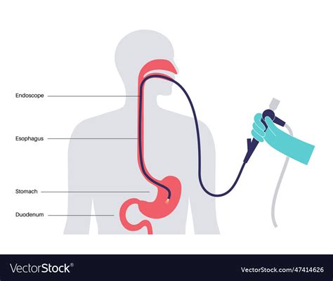Beda Endoscopy Dan Gastroscopy At Liam Threlfall Blog
