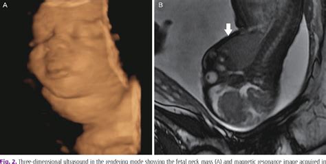 Figure 1 From Fetal Goiter Conservatively Monitored During The Prenatal