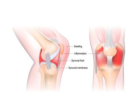 9 Proven Tips On How To Increase Synovial Fluid Bestcheck
