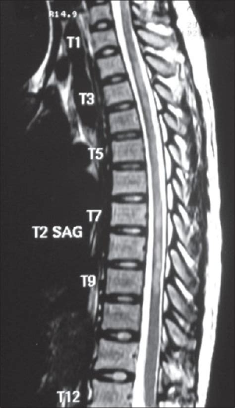 Reversible Neurological Syndromes With Atypical Pneumonia Pmc