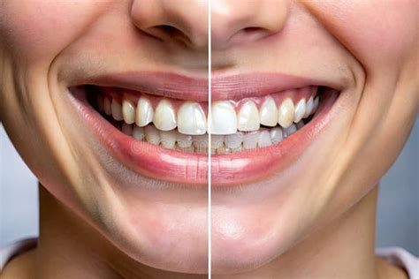 18 Months Of Braces Dramatic Smile Transformation From Uneven To