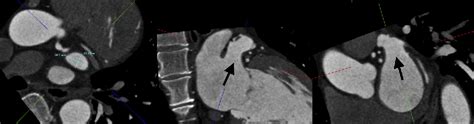 Figure 2 From Cardiac Ct Imaging In The Context Of Left Atrial
