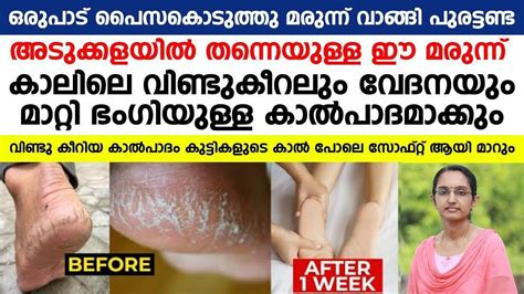 കാലിലെ വിണ്ടുകീറലും വേദനയും മാറ്റാൻ അടുക്കളയിലെ ഈ മരുന്ന് തന്നെ മതി