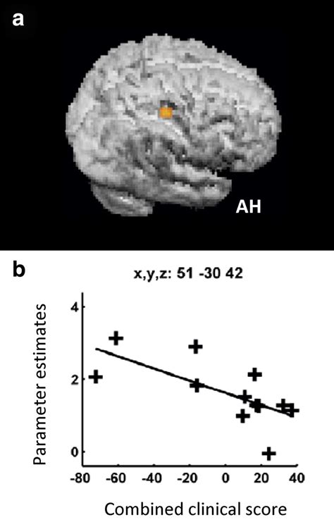 The Role Of Contralesional Dorsal Premotor Cortex After Stroke As