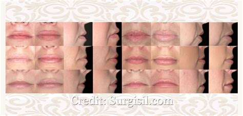 Permanent Lip Implants Are They For You Candylipz