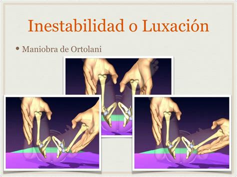 PPT Displasia Evolutiva De Cadera PowerPoint Presentation Free