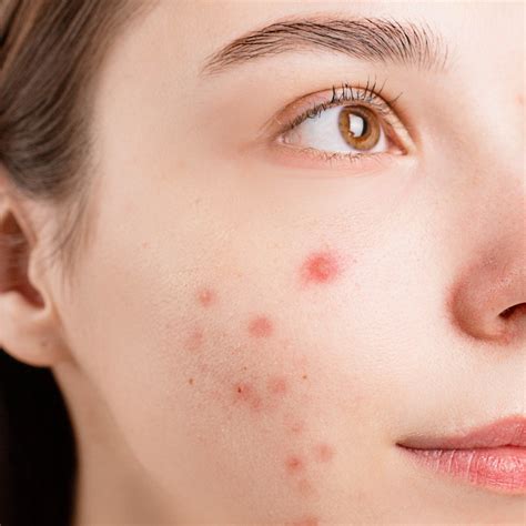 Acne Symptoms Causes Complications And Treatment Ecosh