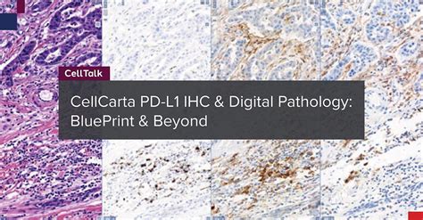 Precision Medicine Pd L1 Ihc Assays Cellcarta Posted On The Topic