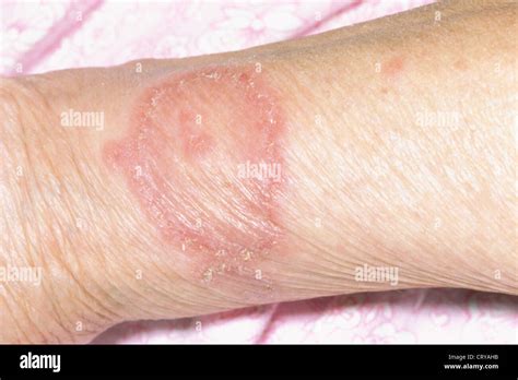 ERYTHEMA ANNULARE CENTRIFUGUM Stock Photo Alamy