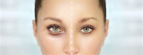 Droopy Eyelid And Ptosis Repair Tucson Cosmetics