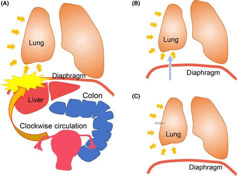 Hypothesized Pathogenesis Of Catamenial Pneumothorax Cp And