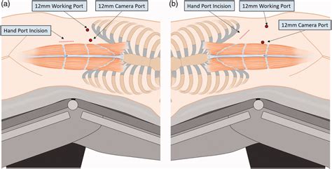 Hand Port Placement And Trocar Sites For Hand Assisted Laparoscopic