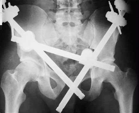 Radiografía Panorámica De Pelvis Con Fijador Externo Download