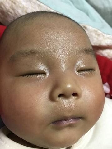 宝宝额头小米粒疙瘩图 孩子 头上 第4页 大山谷图库
