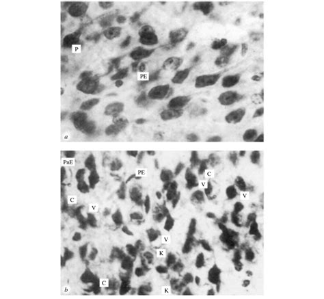 Morphofunctional State Of Neurons In The Temporal Cortex In