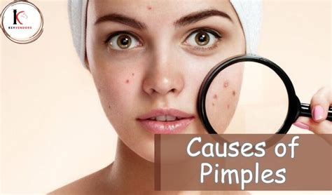 10 Proven Tips To Remove Pimples Your Complete Guide
