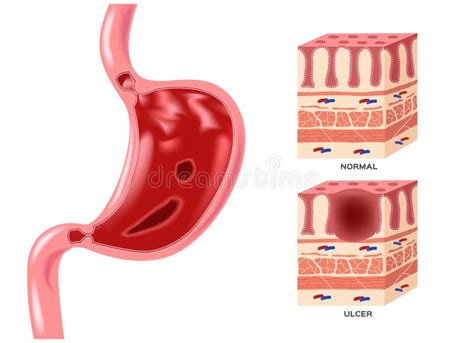 Stomach Peptic Ulcer Helicobacter Pylori Vector Celiac Disease Small