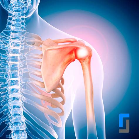 Impingement Syndrome Can Range From Simple Bursitis To A Tearing Of The Rotator Cuff It