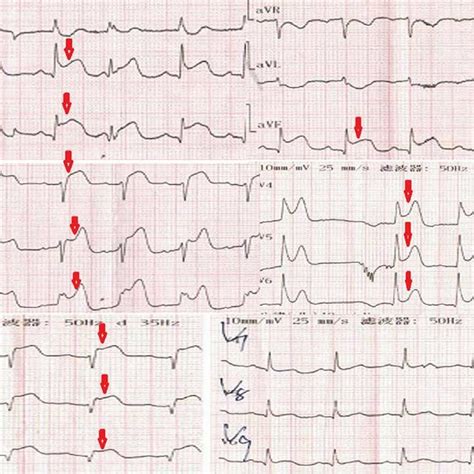 Ecg Findings On Admission Revealing Widespread St Segment Elevation Download Scientific Diagram