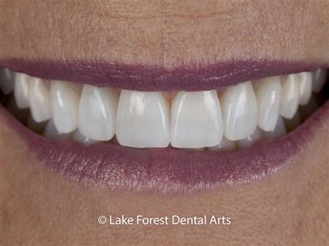 Are Veneers Worth It Upgrade With Dramatic Results