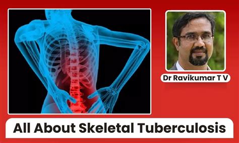 Skeletal Tuberculosis Understanding Its Impact On Bones And Joints Dr Ravikumar T V
