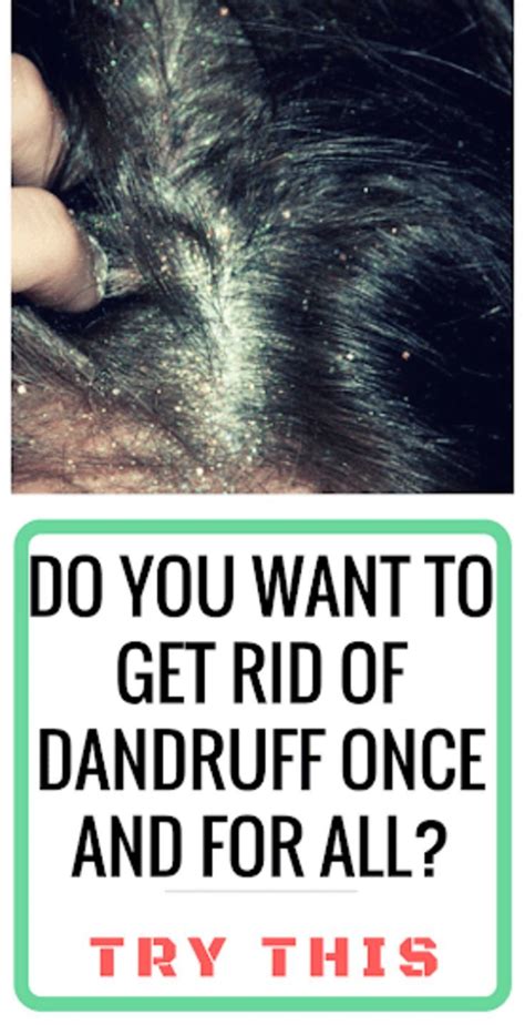 Natural Ways To Eliminate Dandruff