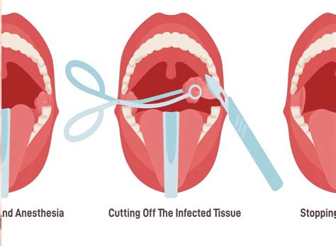 Tonsillectomy Lowcost Surgicals