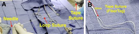 A The Fiberloop Wfibertag Suture Arthrex Features A Reinforced No