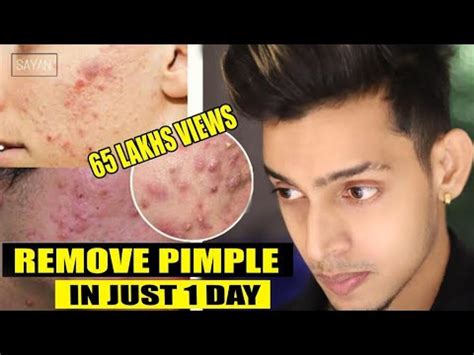 How To Remove Pimples And Dark Spot In Just Day HINDI Skin Care Tips For Men YouTube