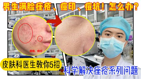 从医学角度，男生如何1个月彻底搞定脸上的 痘痘痘印”，并显著改善痘坑？ 知乎